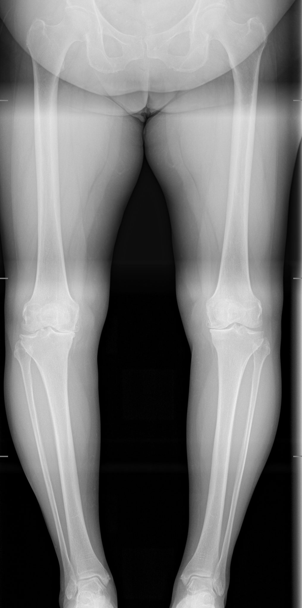 Viršutinės blauzdikaulio dalies valgizuojanti osteotomija – Artroskopija